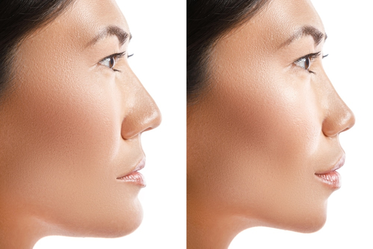How Painful is Orthognathic Surgery?